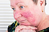 Effektiv behandling mot rosacea